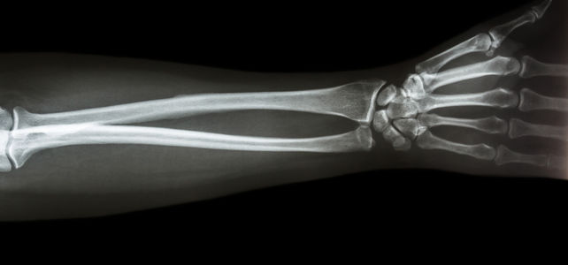 Kindlichen Armbruch im Ultraschall diagnostizieren